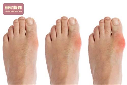 Kháng sinh điều trị gout